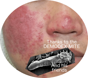 Why Demodex Mites Symptoms and Infestation Require Immediate Attention ...